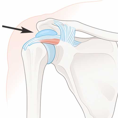 Shoulder Bursitis Treatment Adelaide | Dr Arthur Turow Shoulder Surgeon